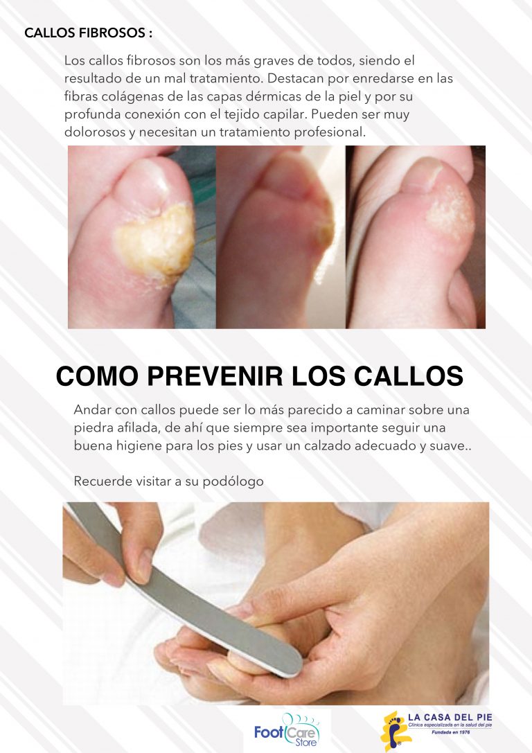 ¿QUE TIPO DE CALLOS TIENES? - LA CASA DEL PIE LTDA